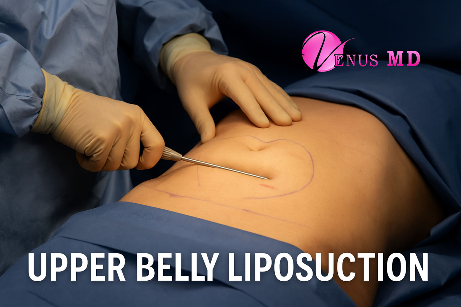 Upper Belly Liposuction: Sculpt Your Midsection at Venus MD